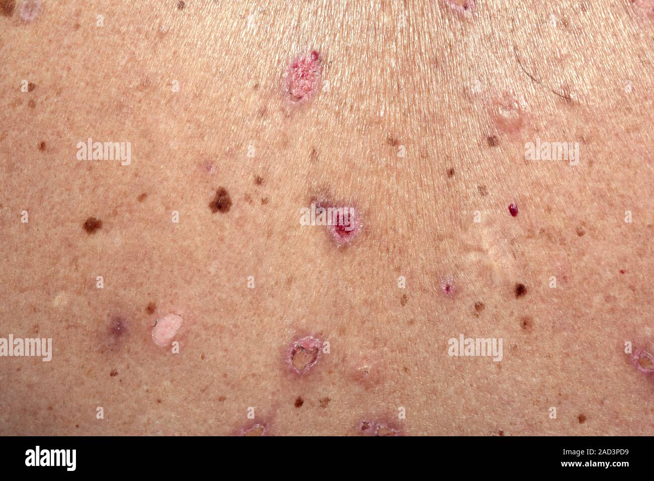 Bullous pemphigoid. Close-up of broken blisters on the skin of a 45 ...
