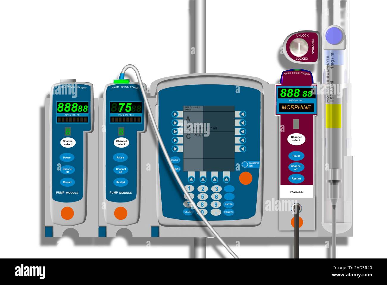 Illustration of a patient controlled analgesia (PCA) intravenous ...