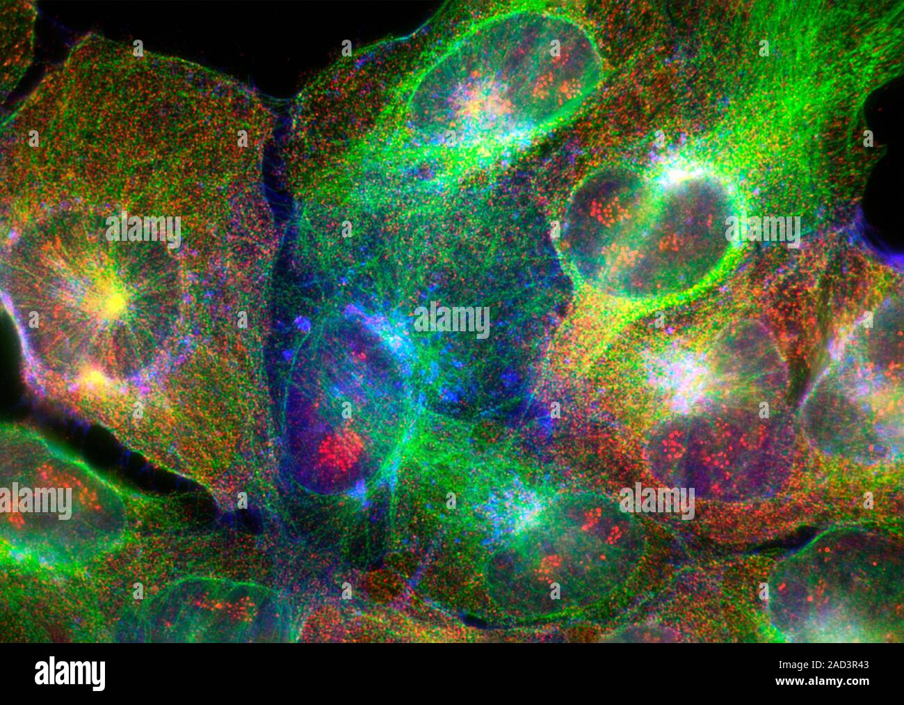 Osteosarcoma cells. Immunofluorescence light micrograph of human ...