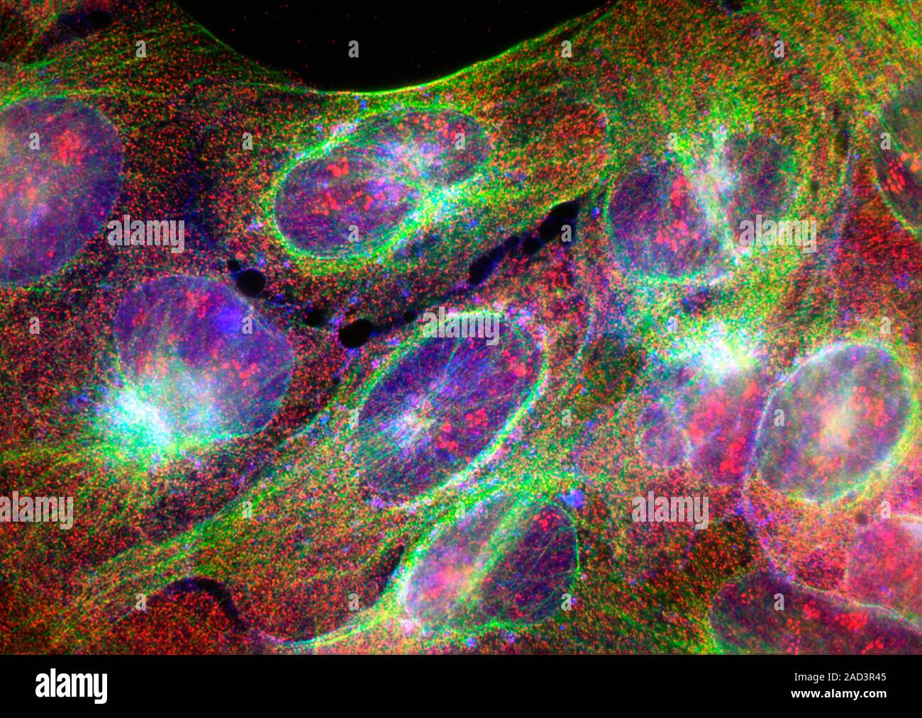 Osteosarcoma cells. Immunofluorescence light micrograph of human ...