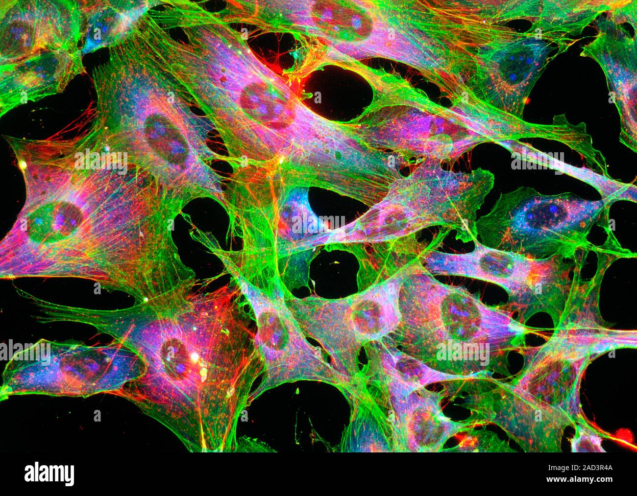 Osteosarcoma cells. Immunofluorescence light micrograph of human ...