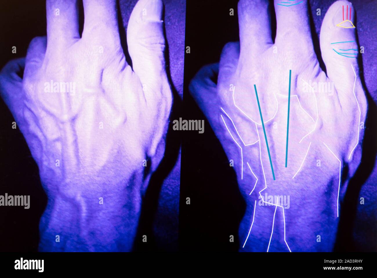 Hand identification research. Enhanced digital photography of the upper ...