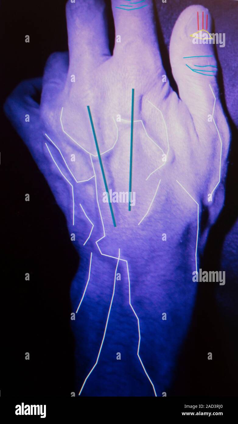 Hand identification research. Enhanced digital photography of the upper ...
