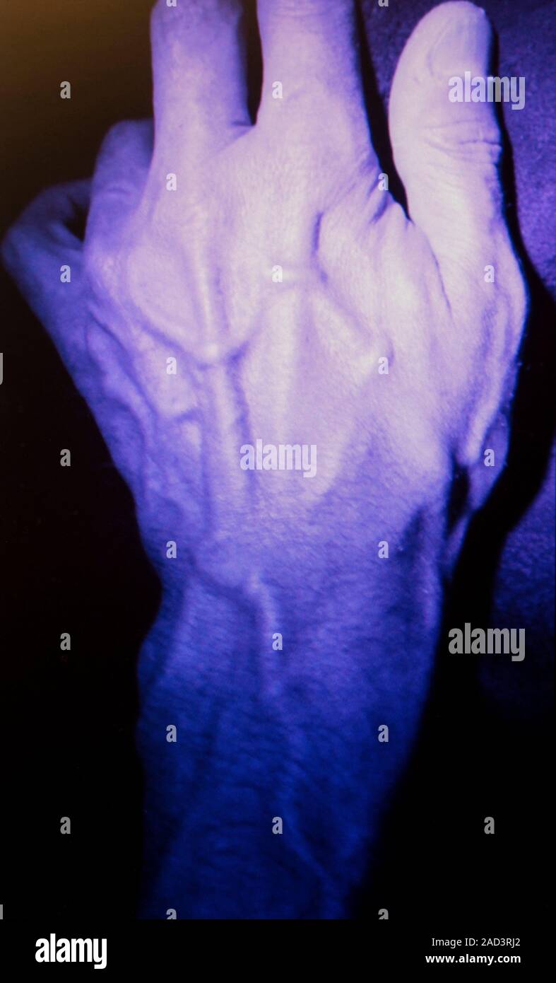 Hand identification research. Enhanced digital photography of the upper ...