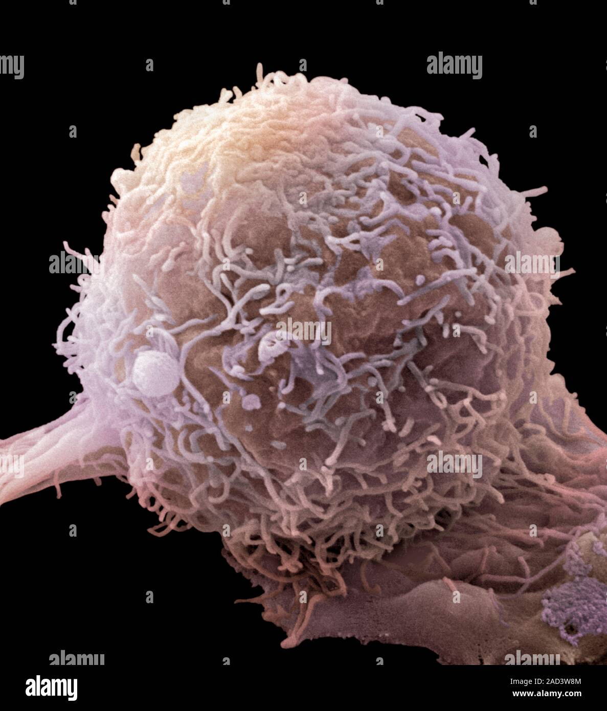 Skin cancer cell, coloured scanning electron micrograph (SEM). Cultured ...