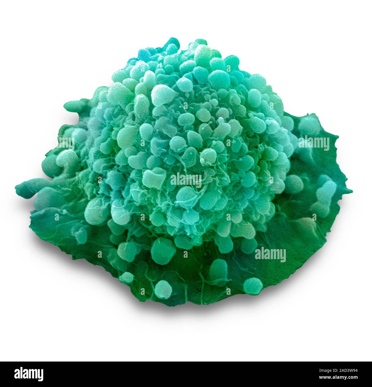 Cervical cancer cell. Coloured scanning electron micrograph (SEM) of a ...