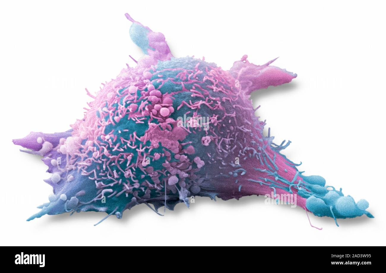 Skin cancer cell, coloured scanning electron micrograph (SEM). Cultured ...