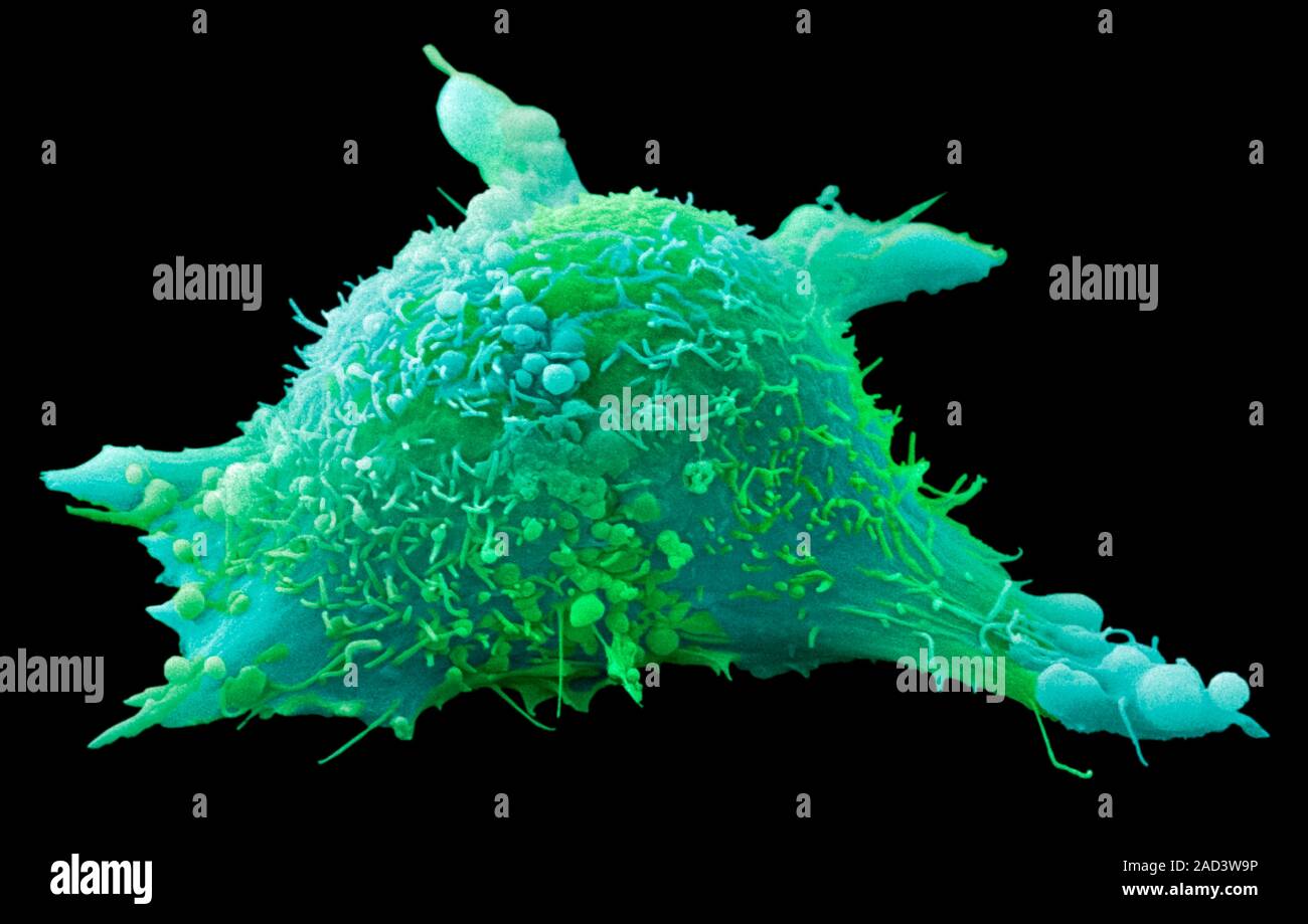 Skin cancer cell, coloured scanning electron micrograph (SEM). Cultured ...