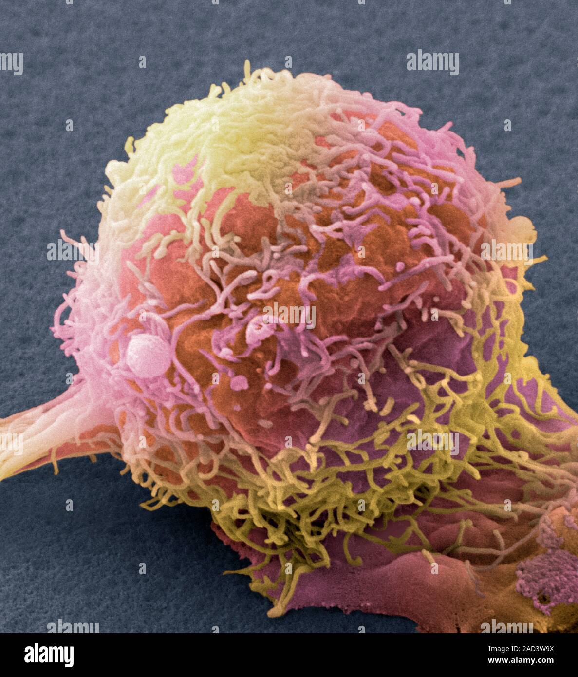Skin cancer cell, coloured scanning electron micrograph (SEM). Cultured ...