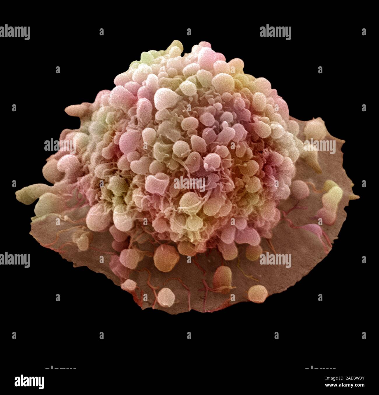Cervical cancer cell. Coloured scanning electron micrograph (SEM) of a ...