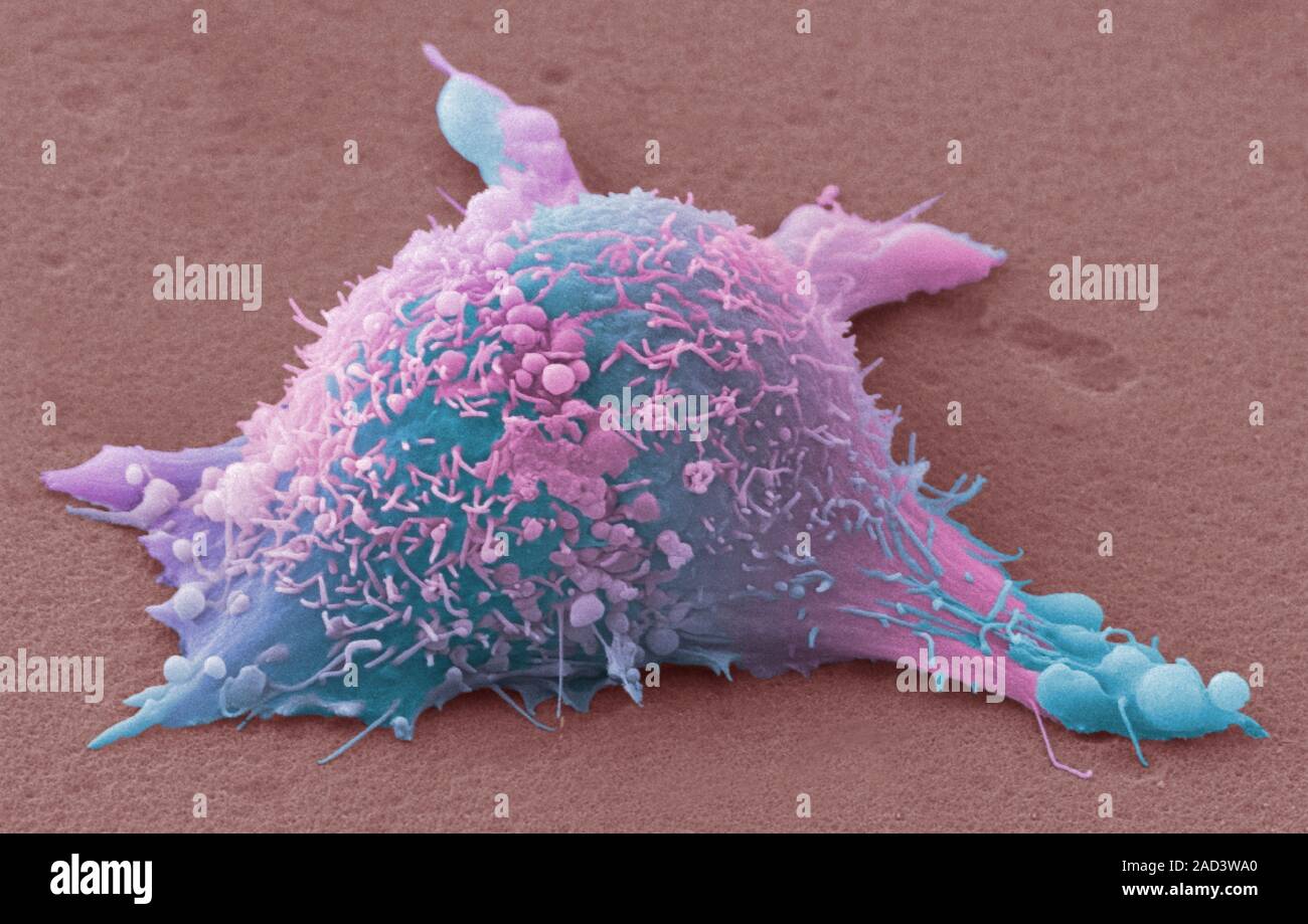 Skin cancer cell, coloured scanning electron micrograph (SEM). Cultured ...