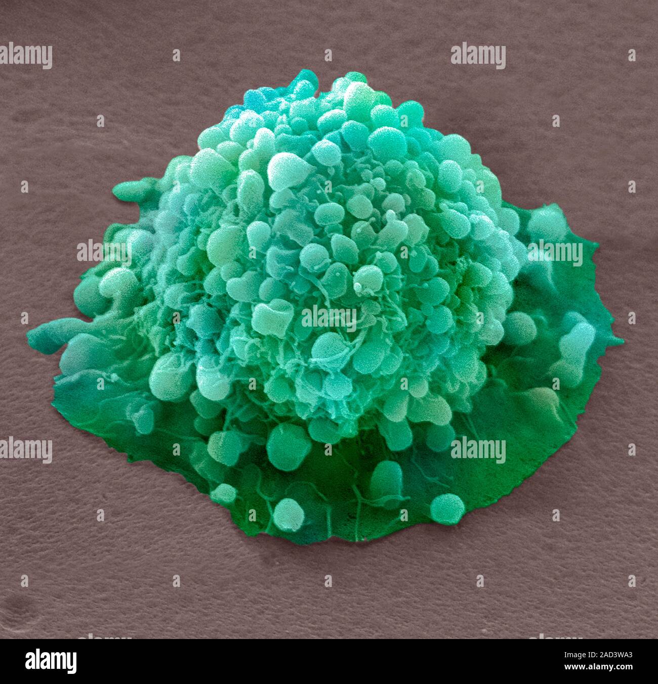 Cervical cancer cell. Coloured scanning electron micrograph (SEM) of a ...