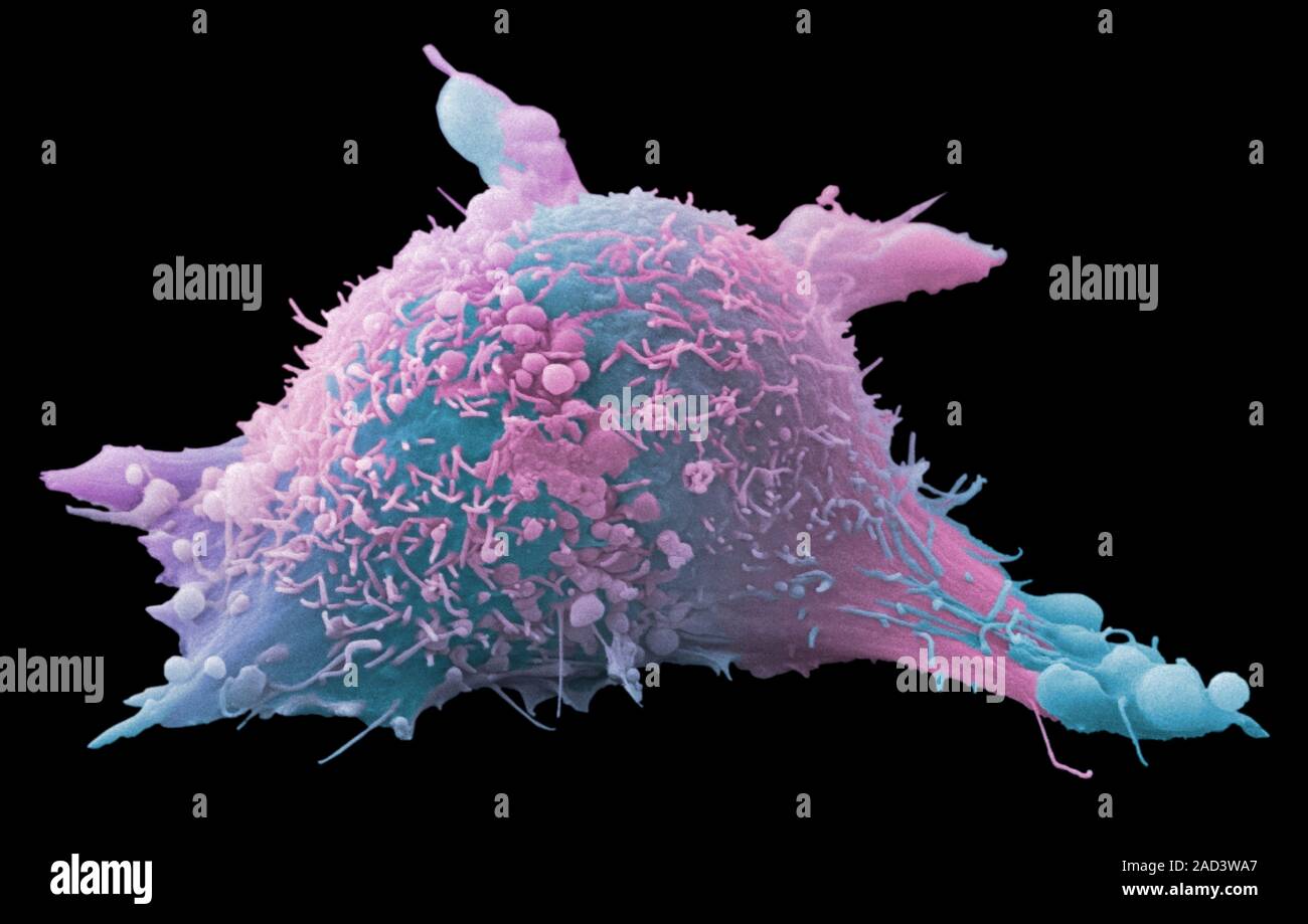 Skin cancer cell, coloured scanning electron micrograph (SEM). Cultured ...