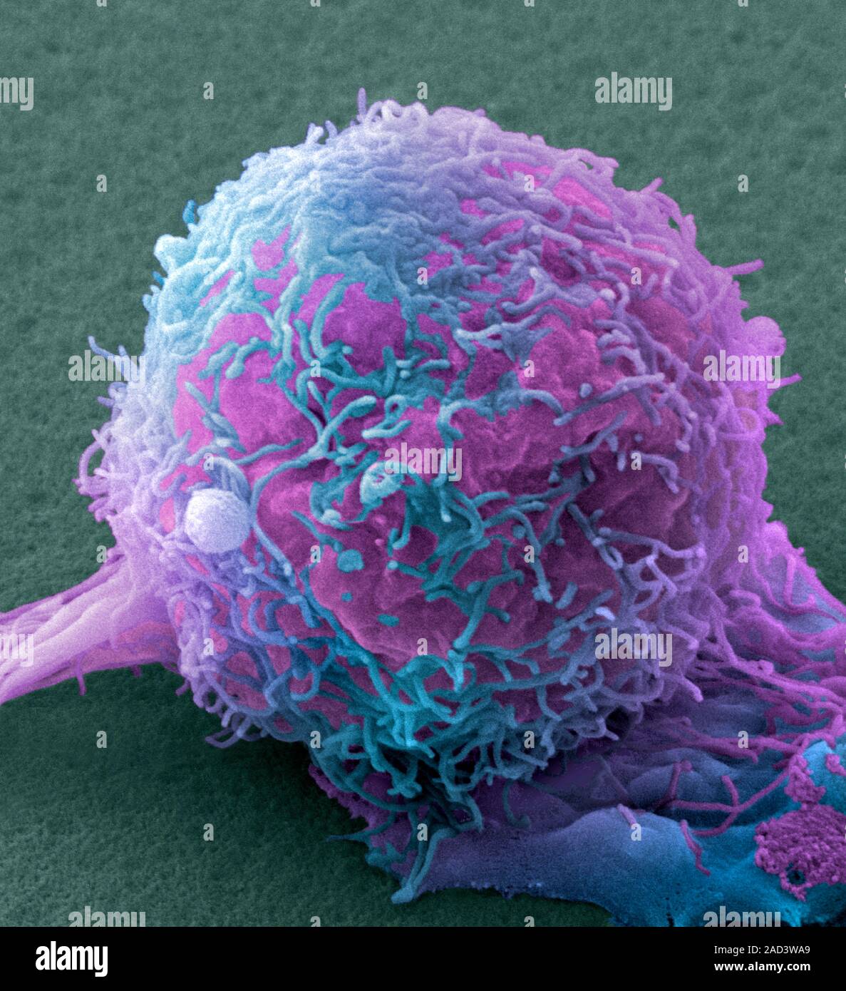Skin cancer cell, coloured scanning electron micrograph (SEM). Cultured ...