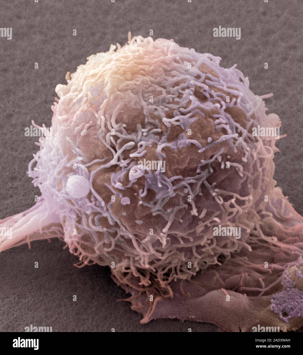 Skin cancer cell, coloured scanning electron micrograph (SEM). Cultured ...