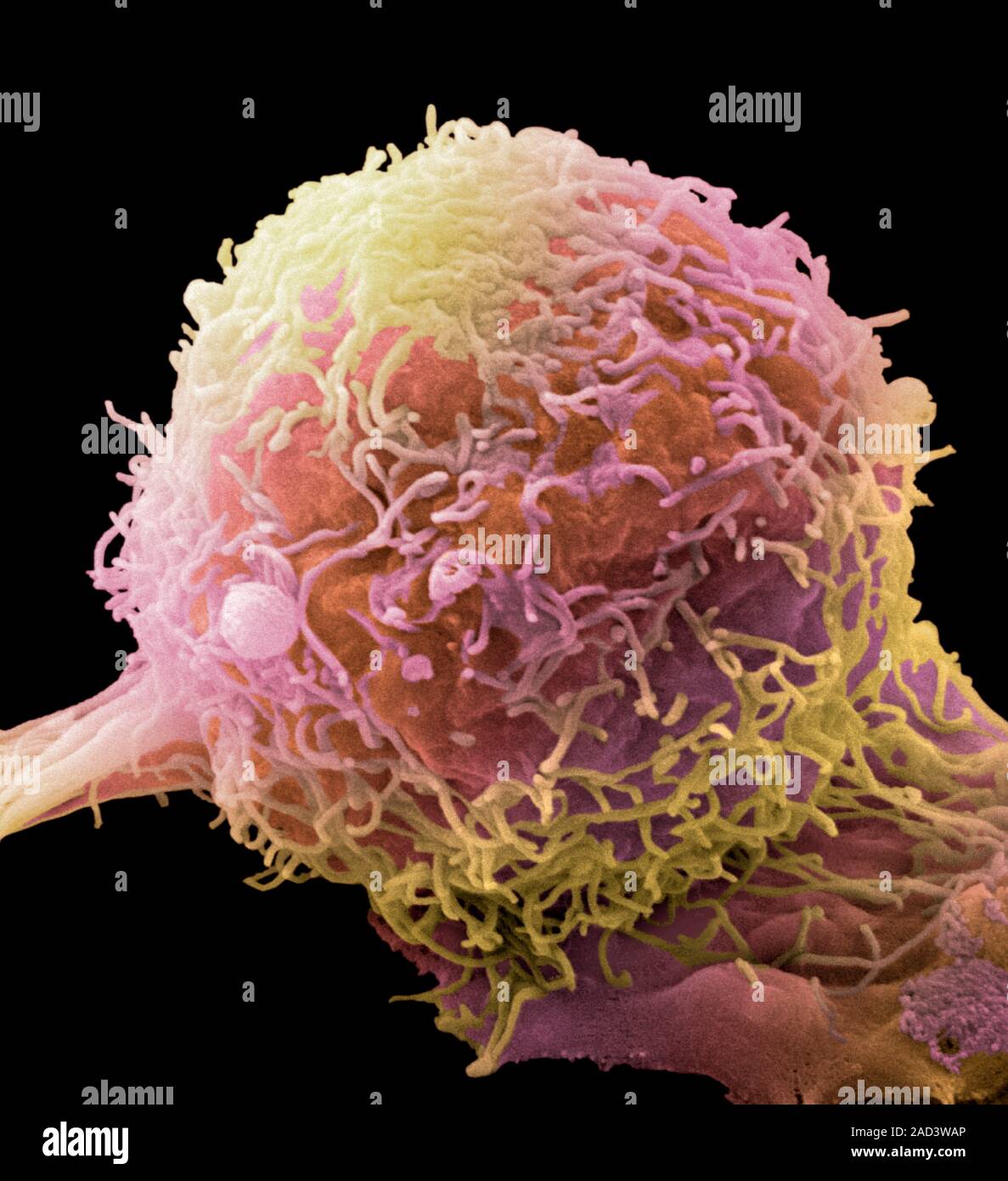 Skin cancer cell, coloured scanning electron micrograph (SEM). Cultured ...