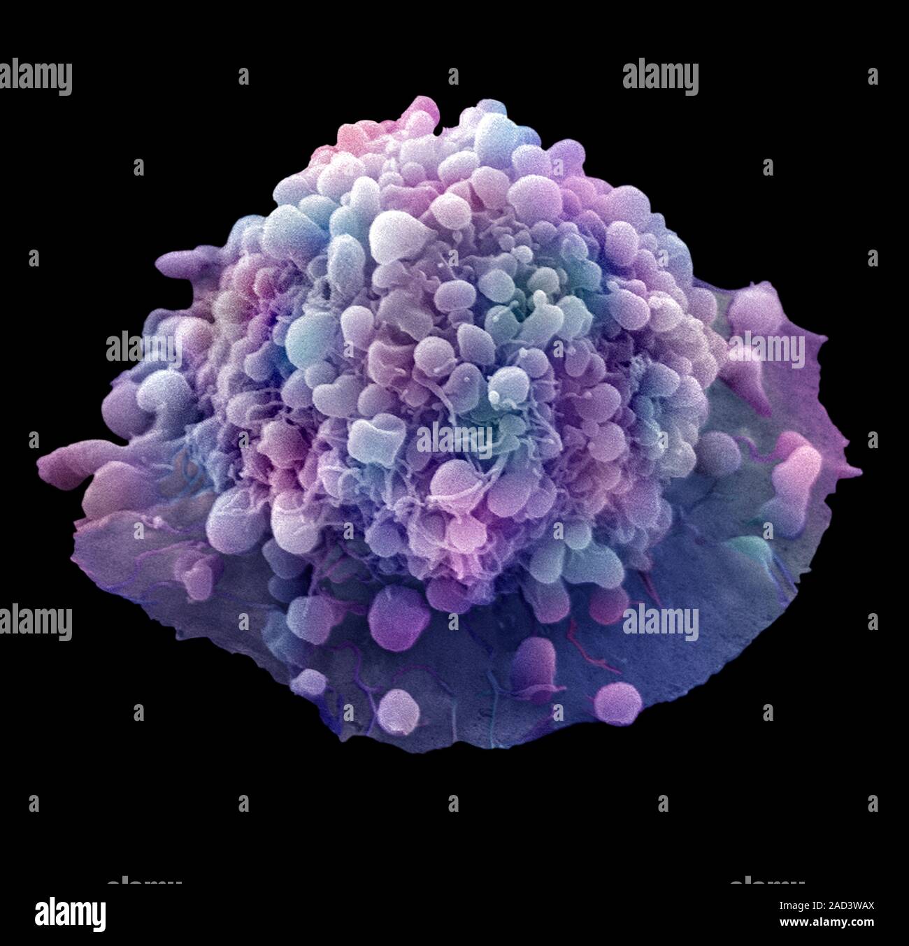 Cervical cancer cell. Coloured scanning electron micrograph (SEM) of a ...