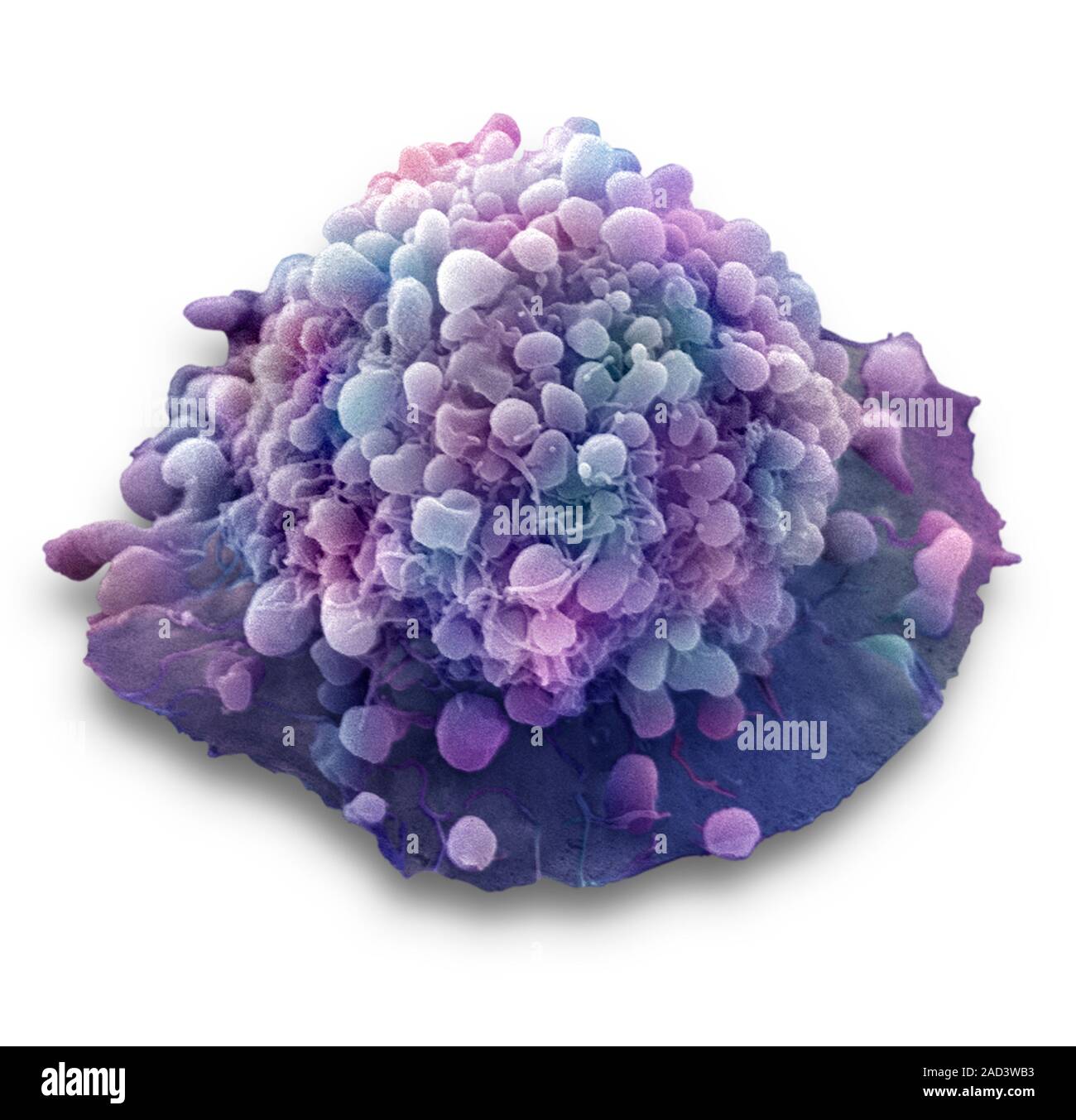 Cervical cancer cell. Coloured scanning electron micrograph (SEM) of a ...