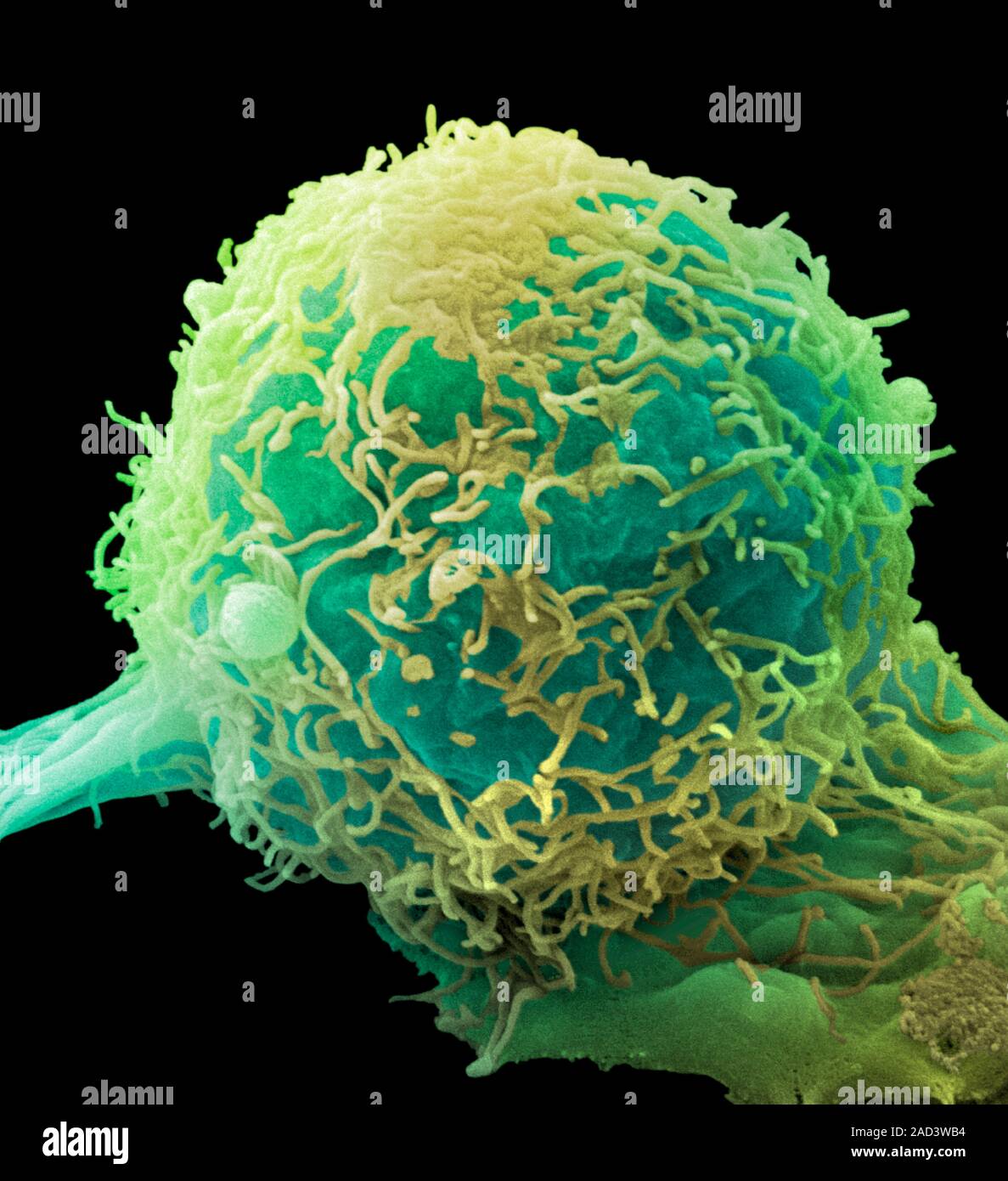 Skin cancer cell, coloured scanning electron micrograph (SEM). Cultured ...
