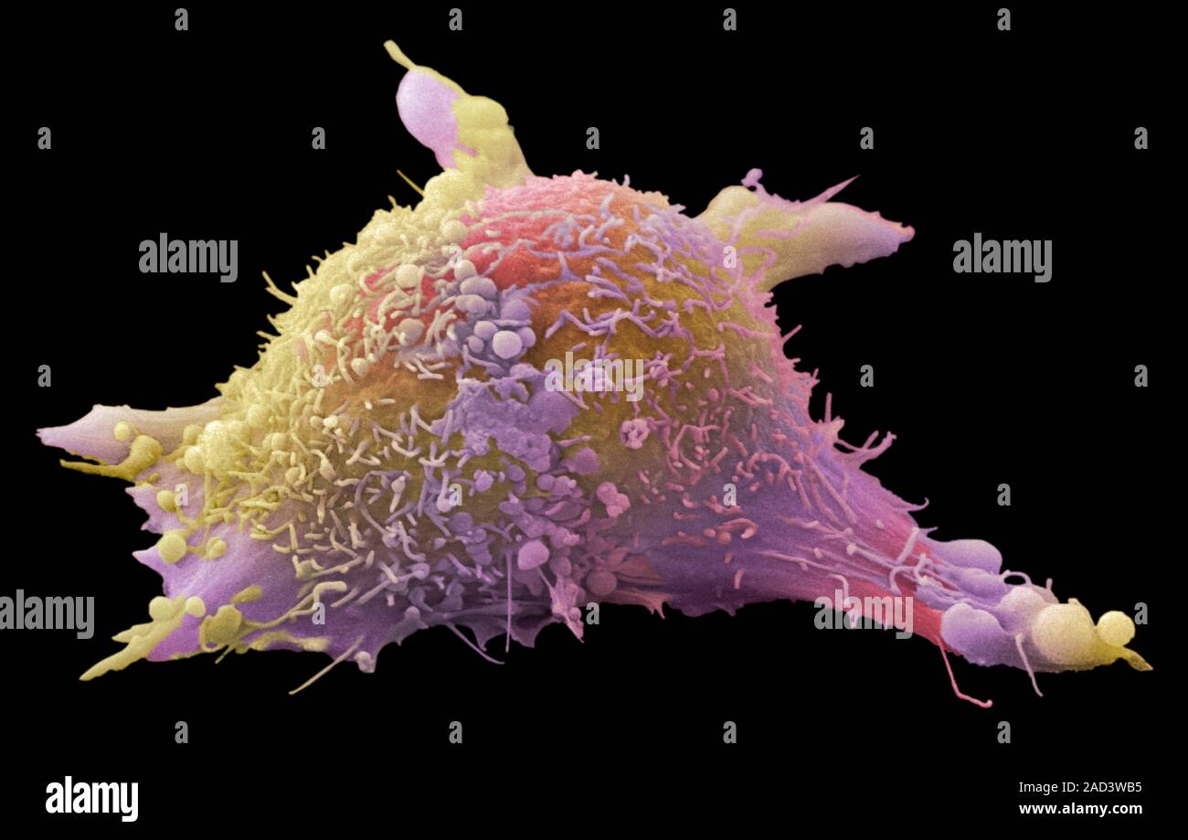 Skin cancer cell, coloured scanning electron micrograph (SEM). Cultured ...