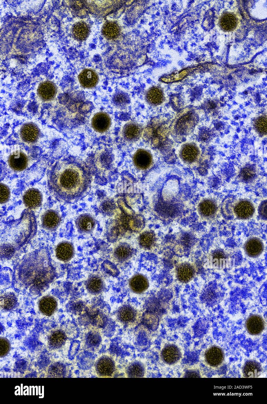 Herpes simplex virus infection. Coloured transmission electron ... Herpes simplex virus infection. Coloured transmission electron ...