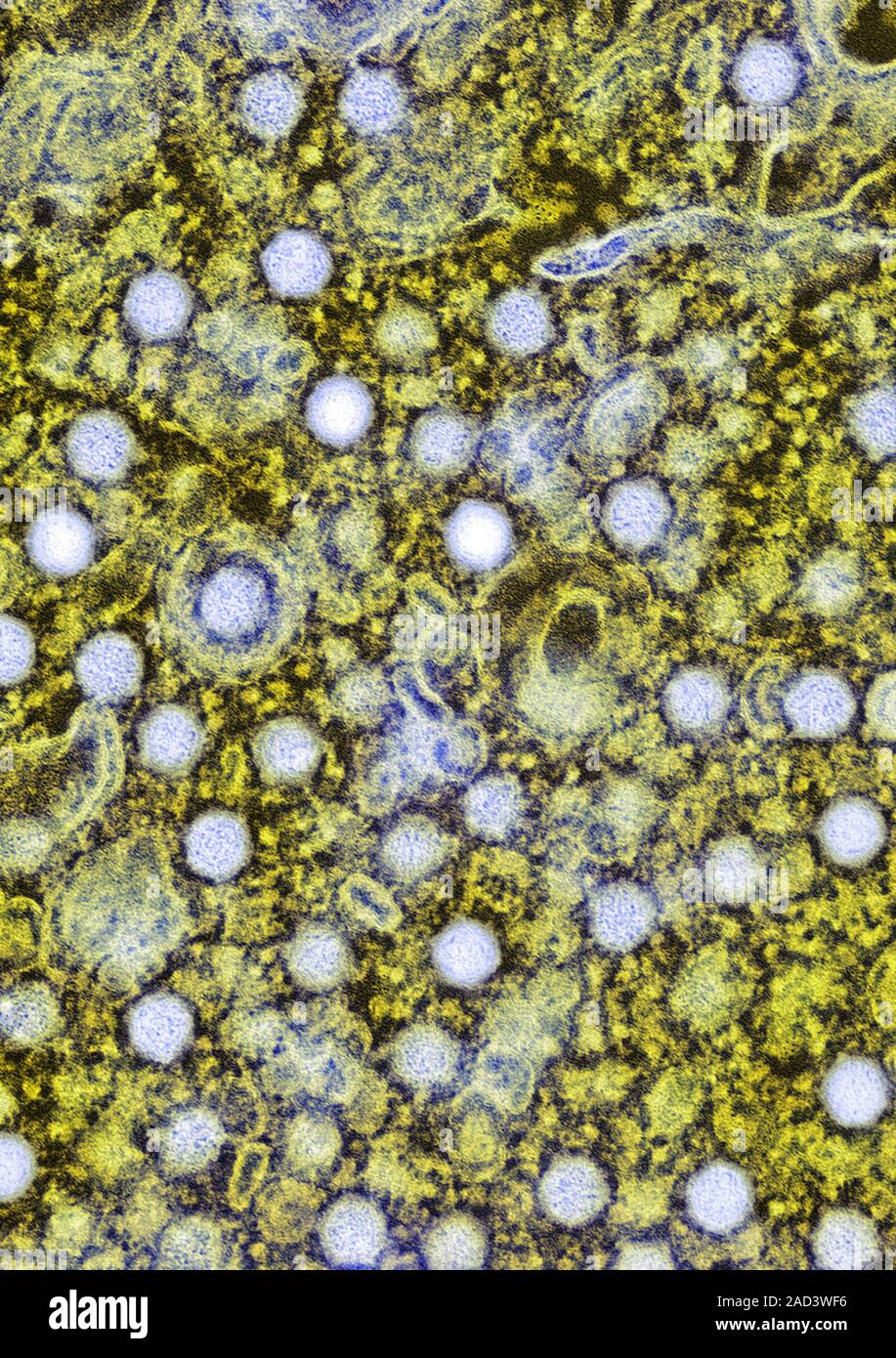 Herpes simplex virus infection. Coloured transmission electron ...