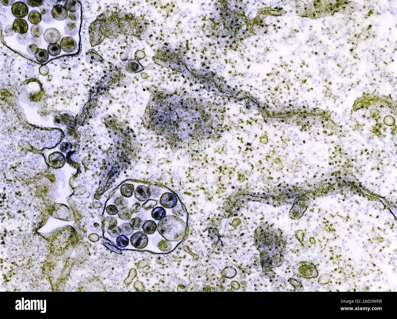 HIV infection. Coloured transmission electron micrograph (TEM) of a ...