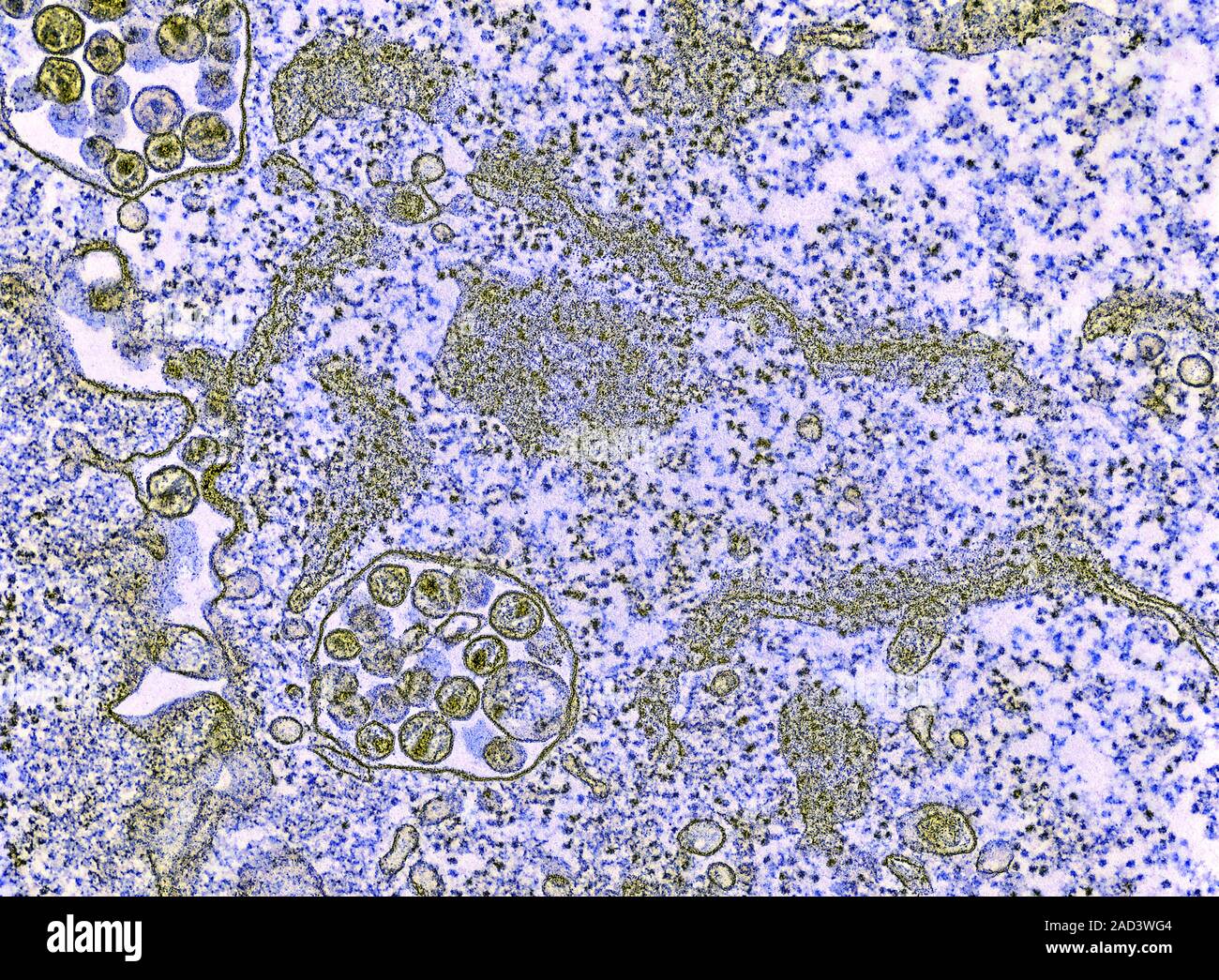 HIV infection. Coloured transmission electron micrograph (TEM) of a ...