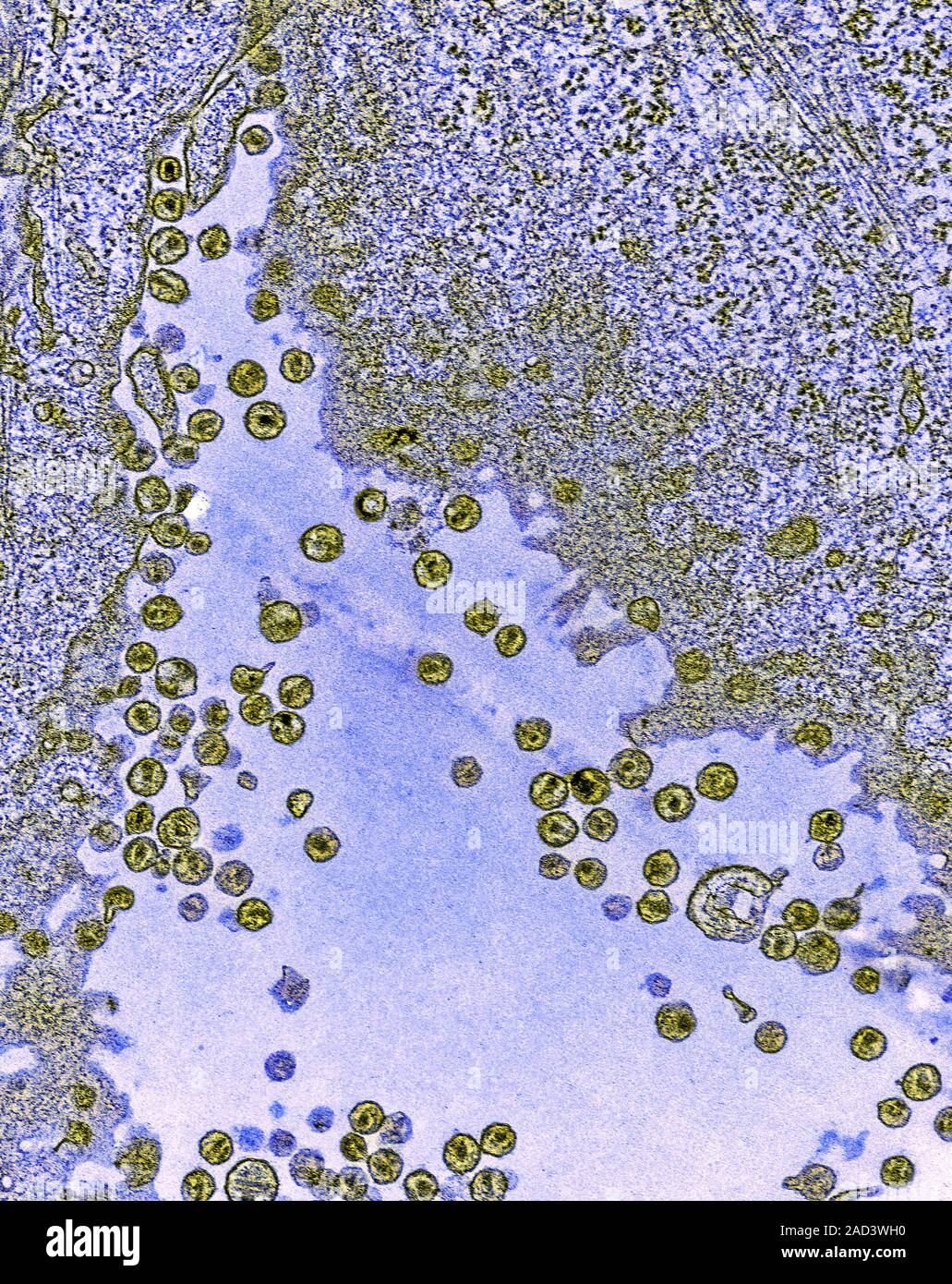 HIV infection. Coloured transmission electron micrograph (TEM) of a ...