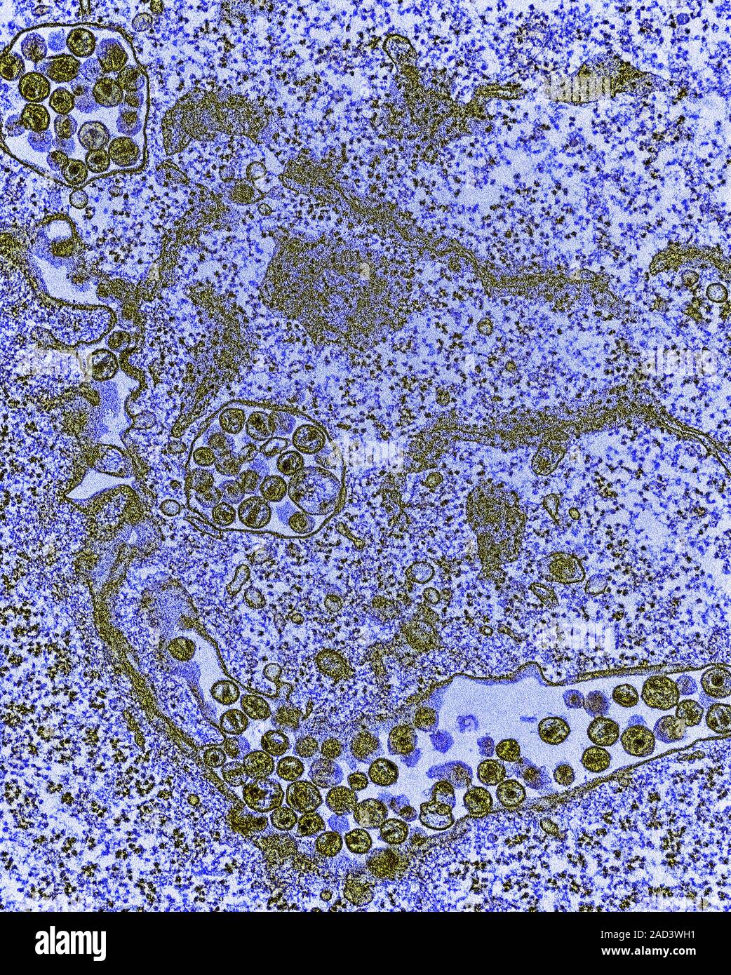 HIV infection. Coloured transmission electron micrograph (TEM) of a ...