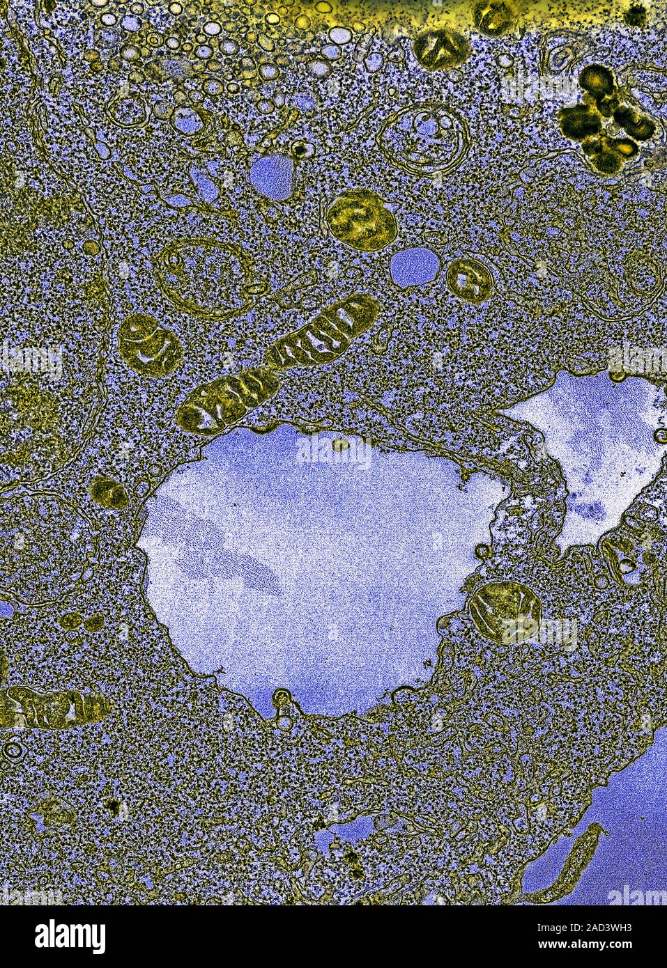 HIV infection. Coloured transmission electron micrograph (TEM) of a ...