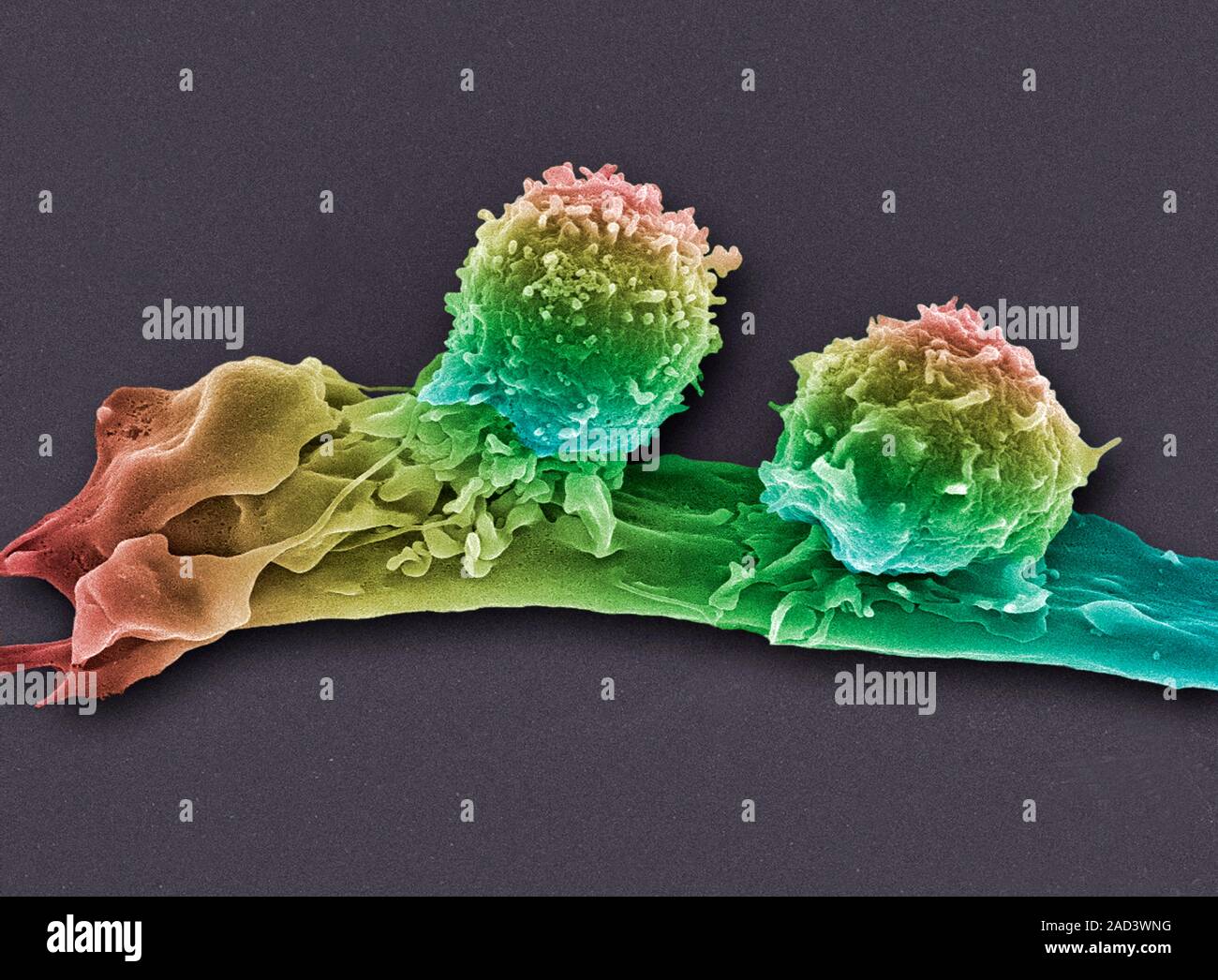 T lymphocytes and cancer cell. Coloured scanning electron micrograph ...