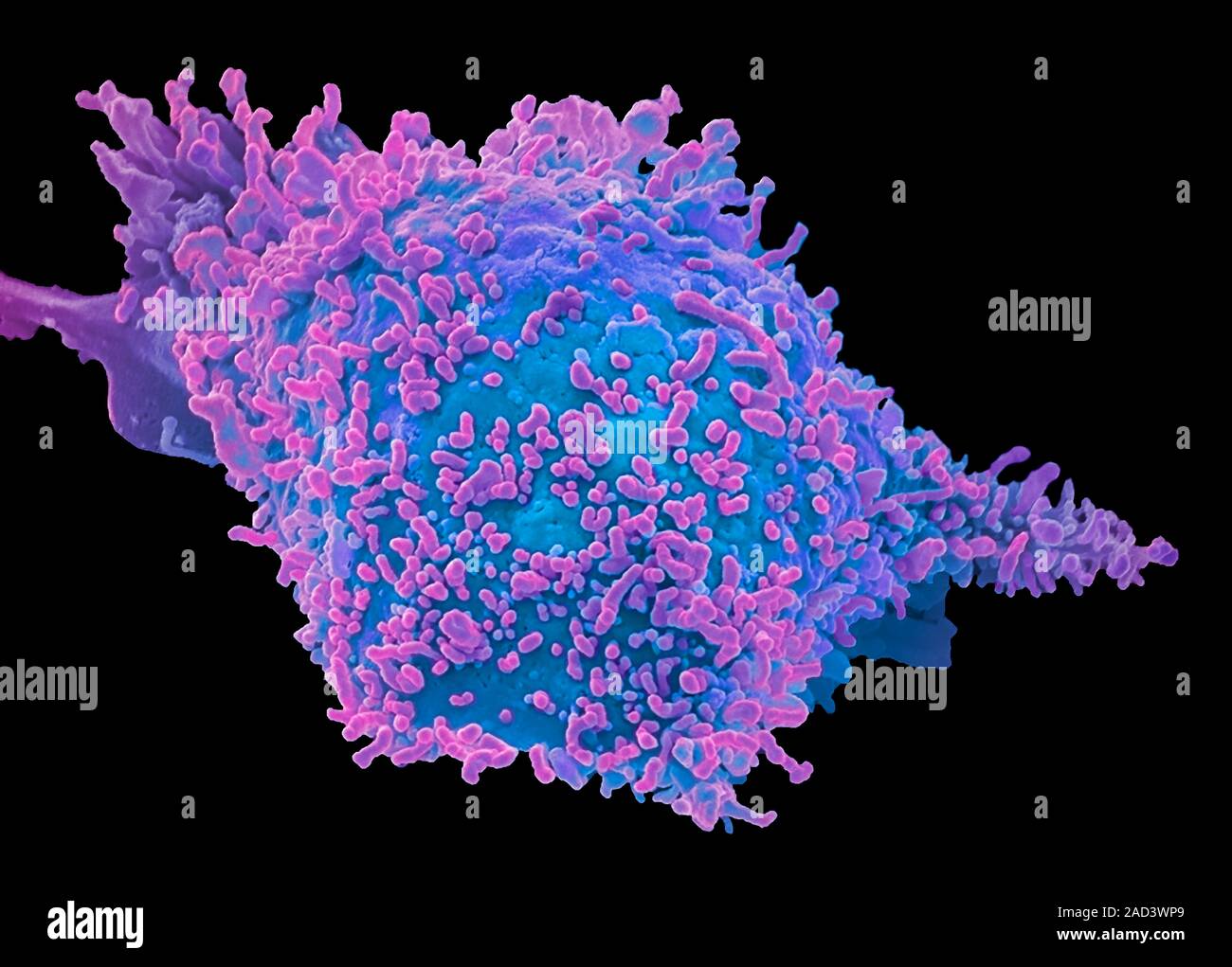 Fibrosarcoma cell. Coloured scanning electron micrograph of a ...