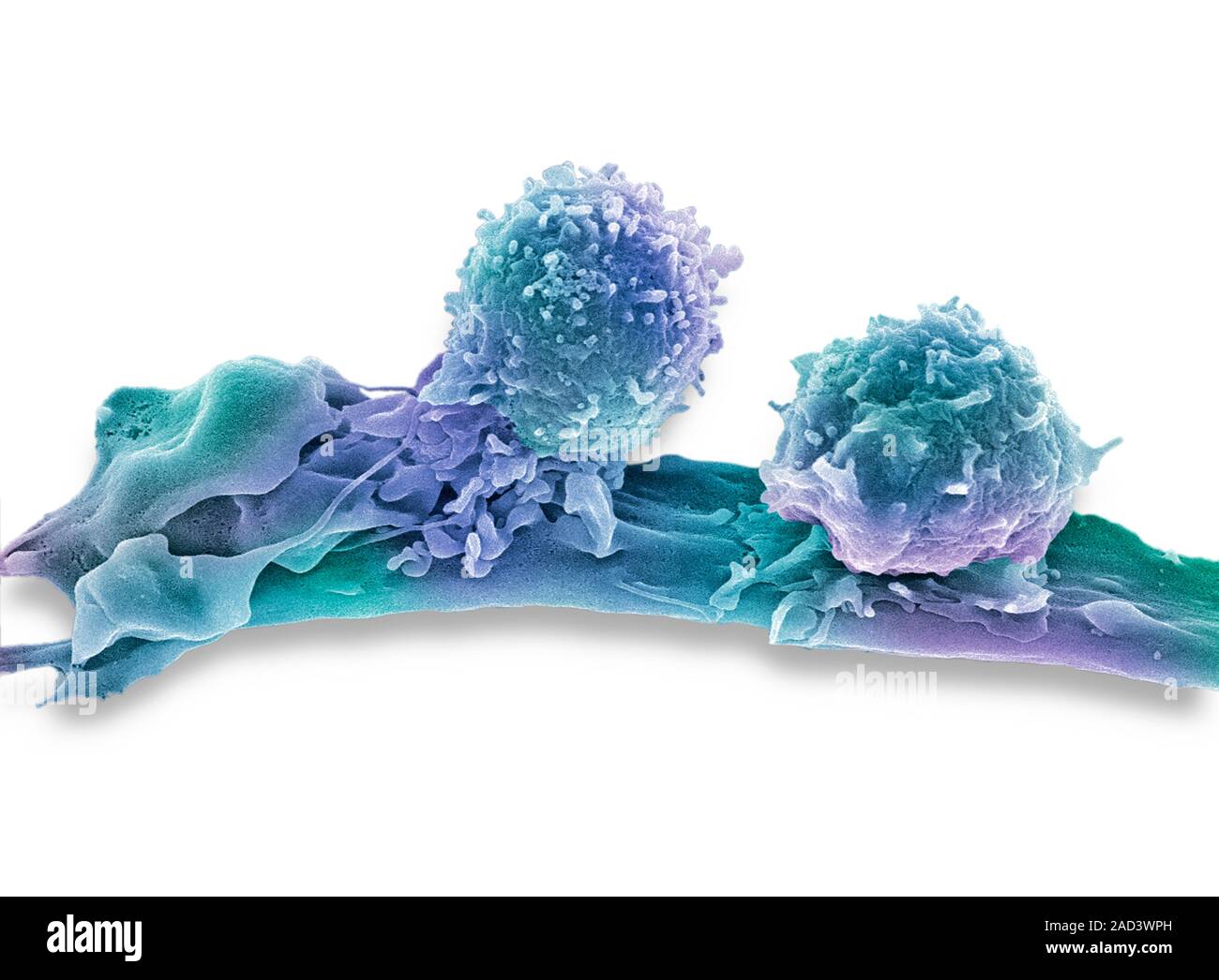 T lymphocytes and cancer cell. Coloured scanning electron micrograph ...