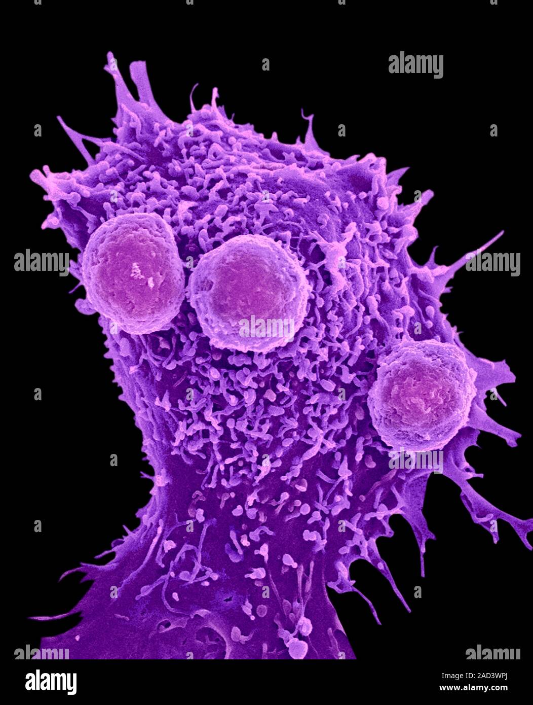 T lymphocytes and cancer cell. Coloured scanning electron micrograph ...