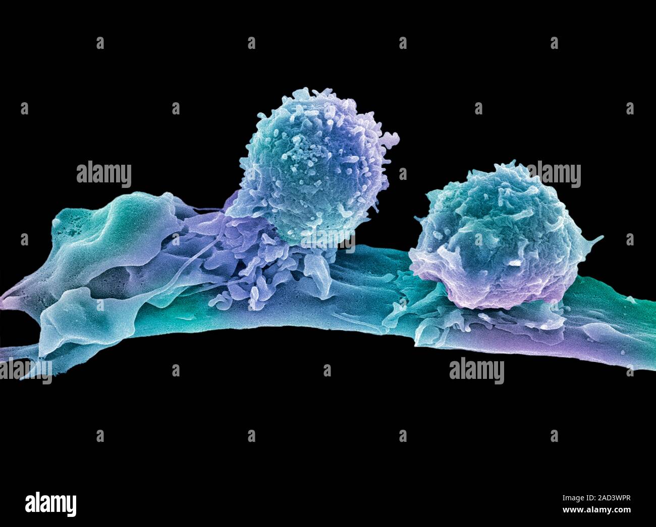 T lymphocytes and cancer cell. Coloured scanning electron micrograph ...