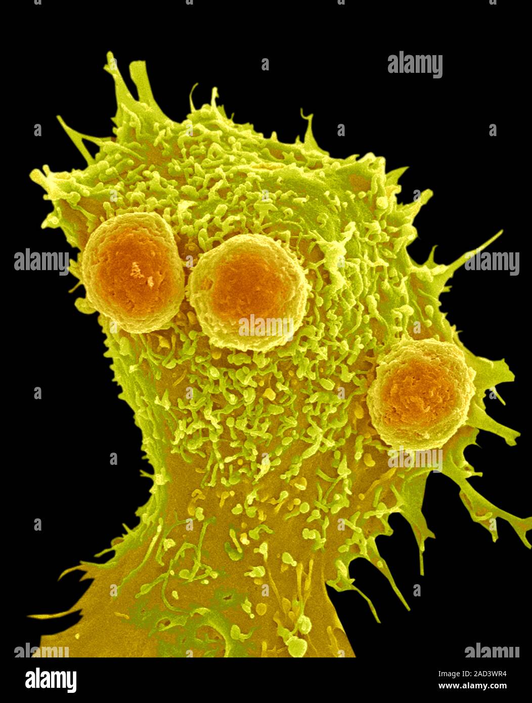 T lymphocytes and cancer cell. Coloured scanning electron micrograph ...