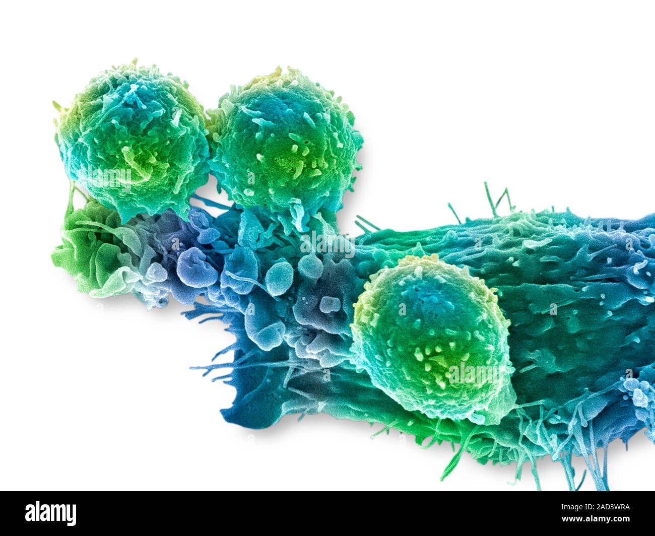 T lymphocytes and cancer cell. Coloured scanning electron micrograph ...