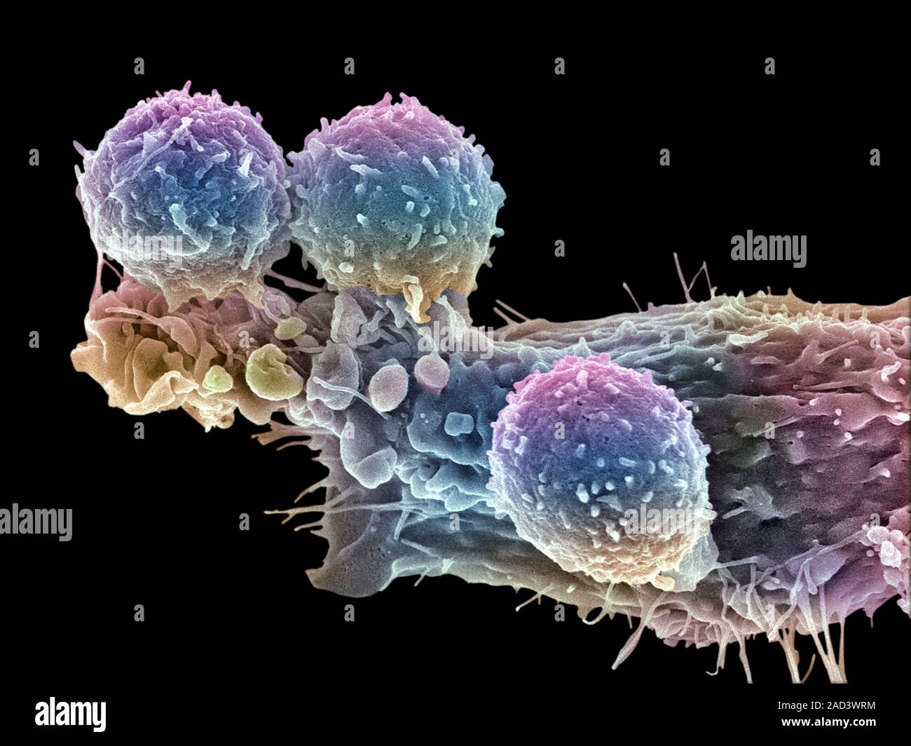 T lymphocytes and cancer cell. Coloured scanning electron micrograph ...