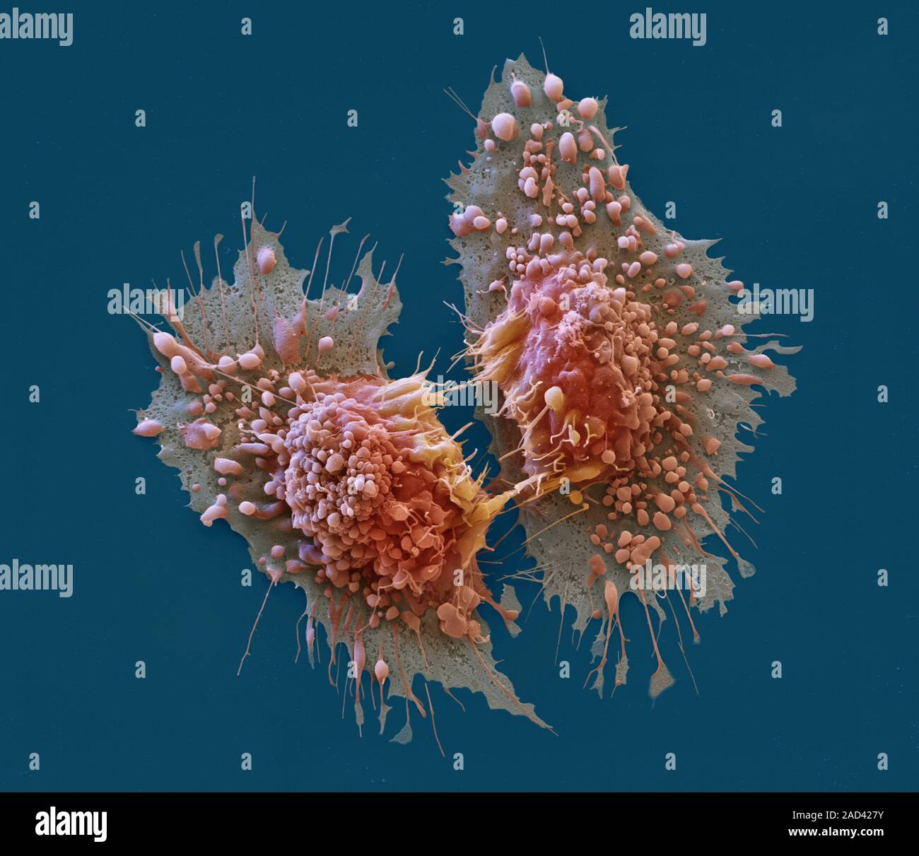 Cancer cells. Coloured scanning electron micrograph (SEM) of two ...