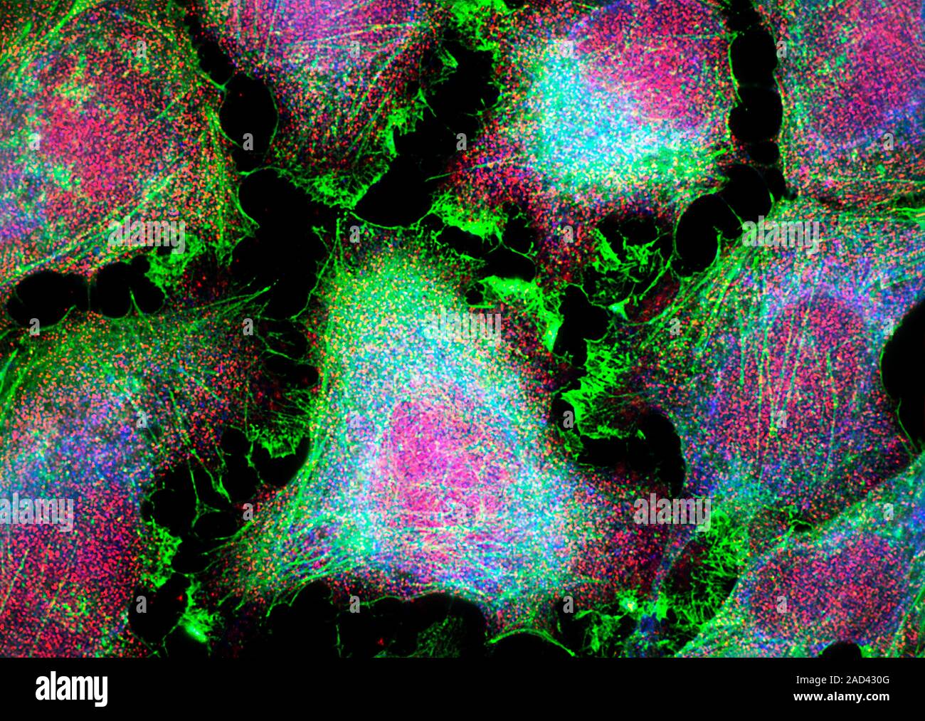 Osteosarcoma cells. Immunofluorescence light micrograph of human ...