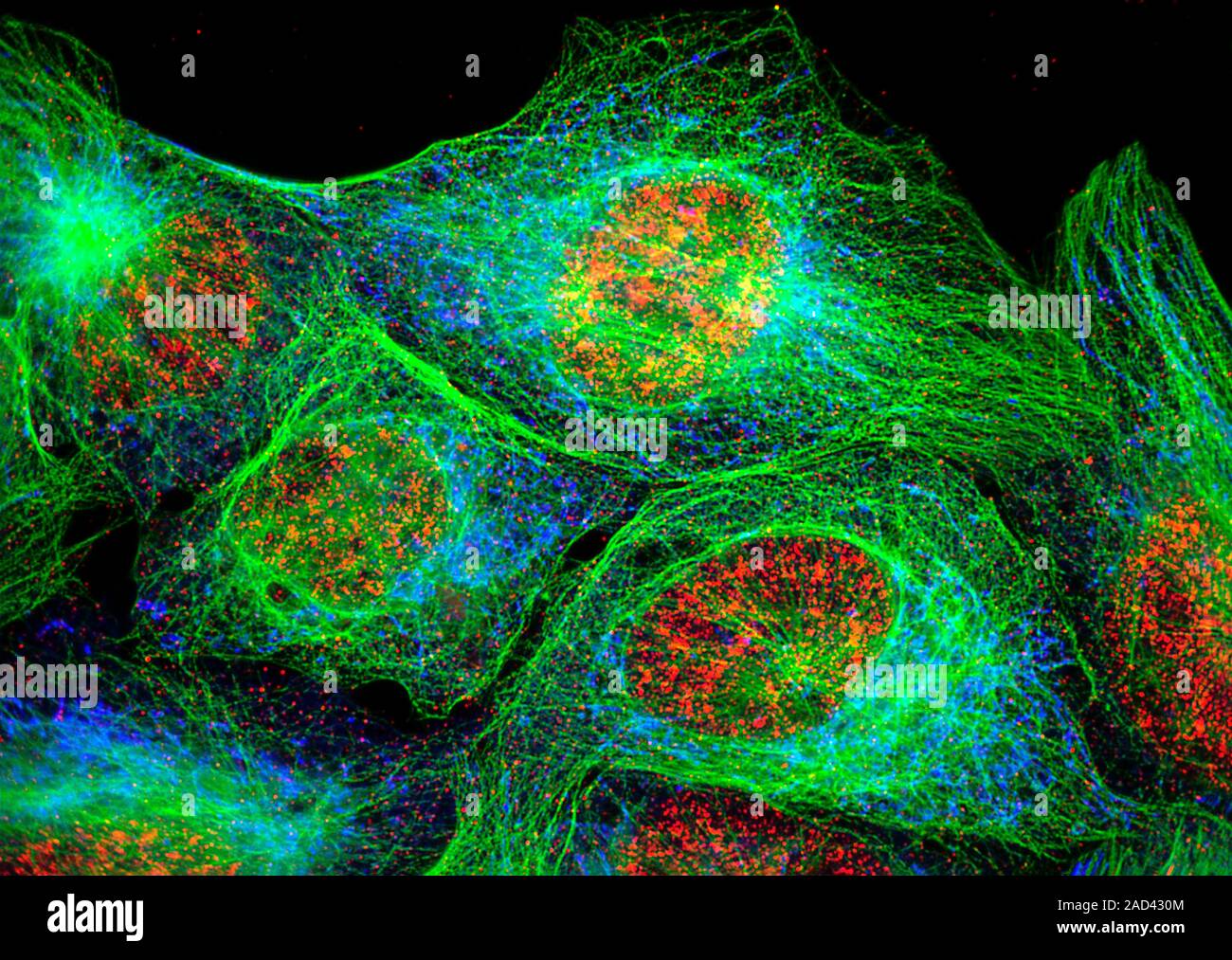 Osteosarcoma cells. Immunofluorescence light micrograph of human ...