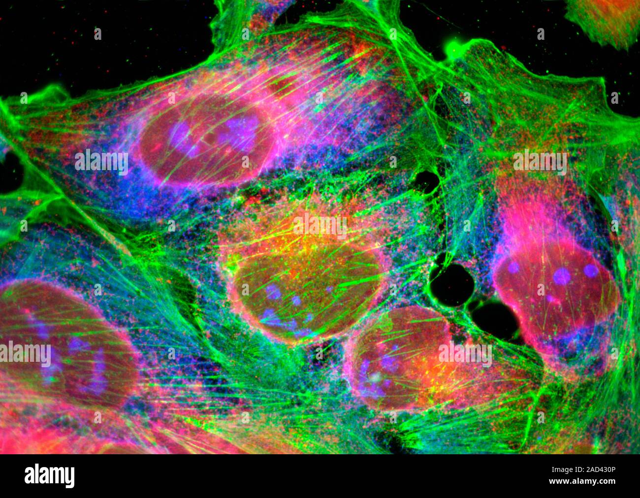 Osteosarcoma cells. Immunofluorescence light micrograph of human ...