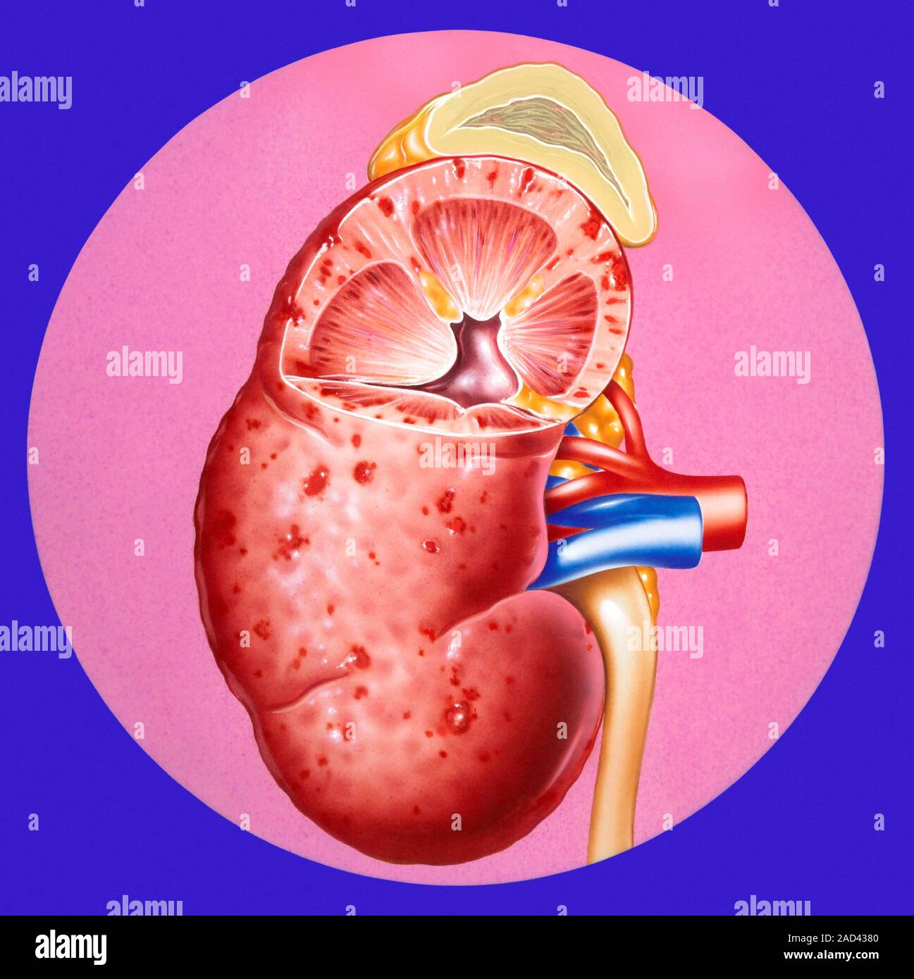 Kidney in renal hypertension. Cutaway illustration of the effects of ...