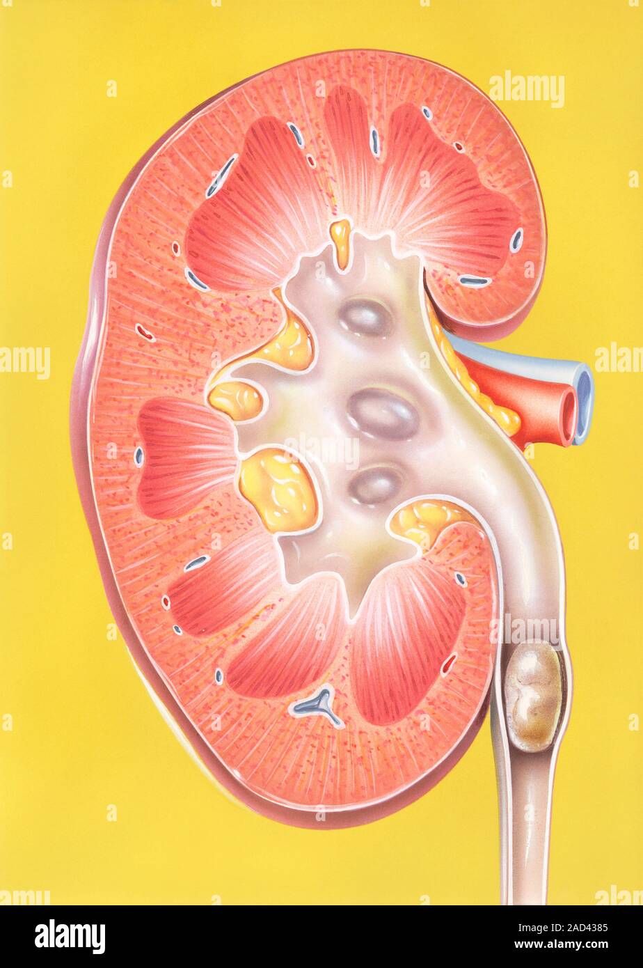 Kidney stone in the ureter. Illustration of a sectioned kidney, showing ...