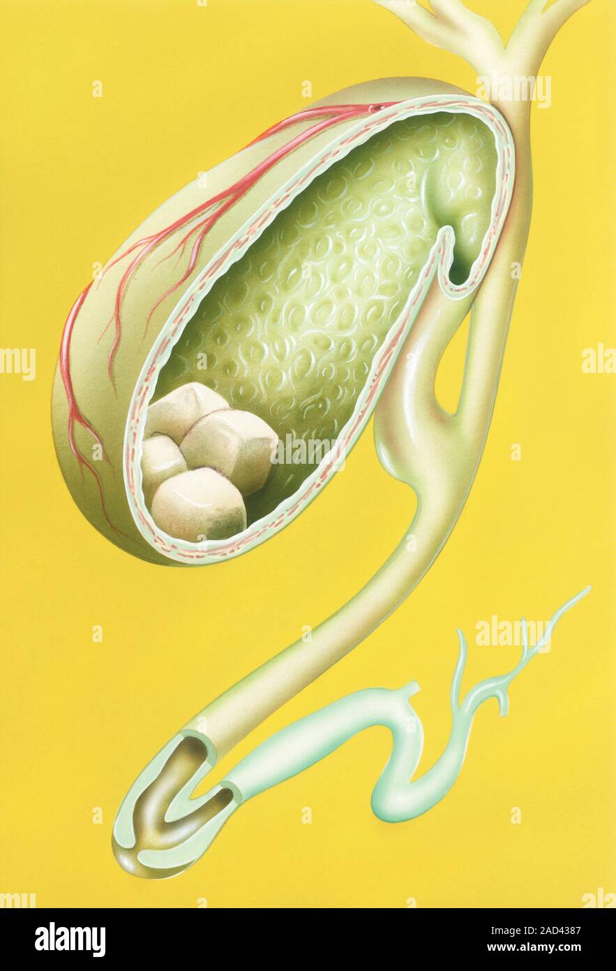 Gallstones in gallbladder. Cutaway illustration of gallstones (centre ...