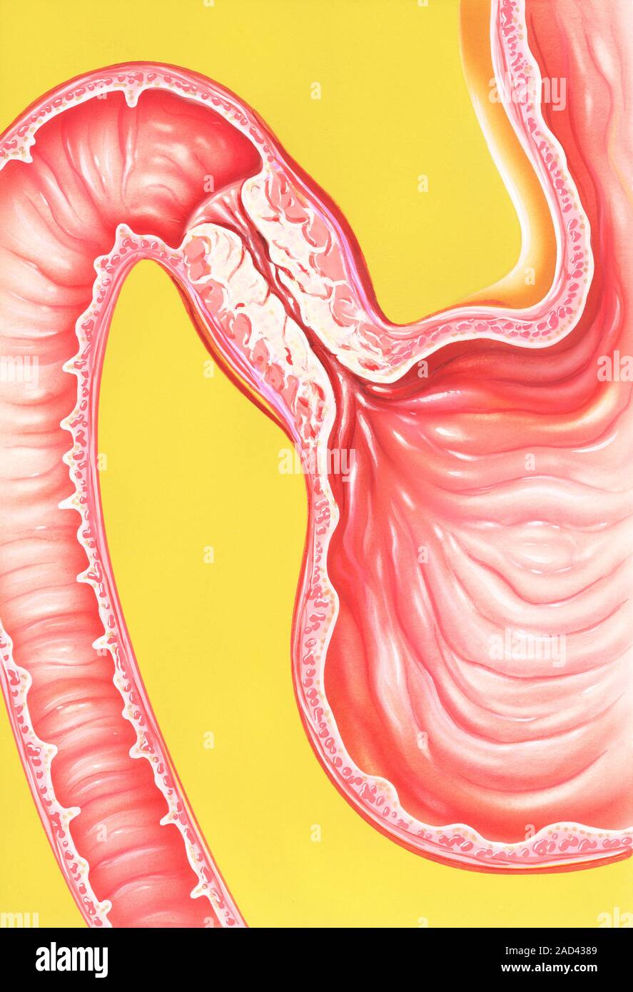 Cancer of the stomach. Illustration of a sectioned view of the stomach ...