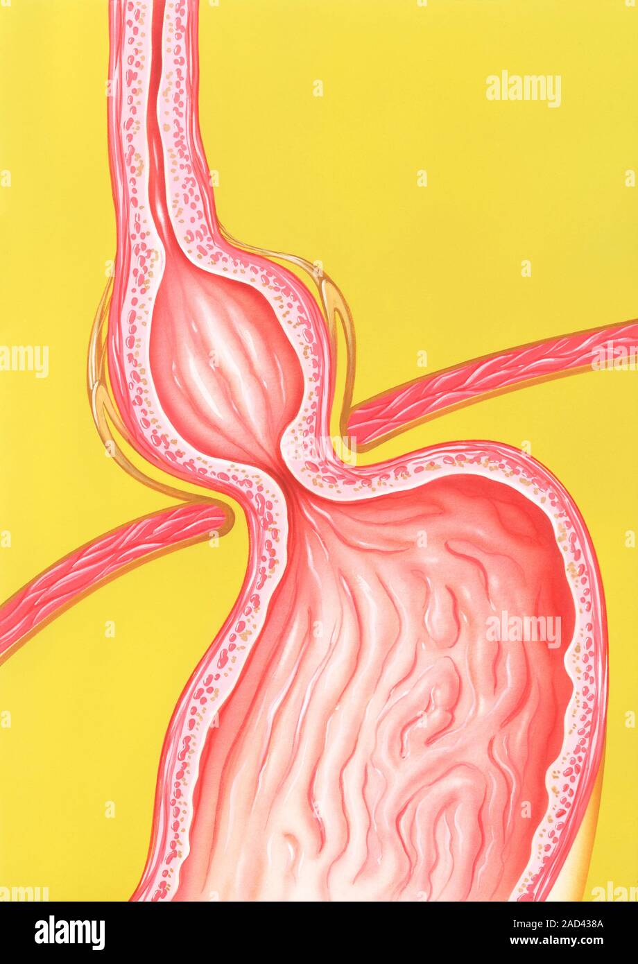 Hiatus hernia. Illustration of a sectioned view through the stomach ...