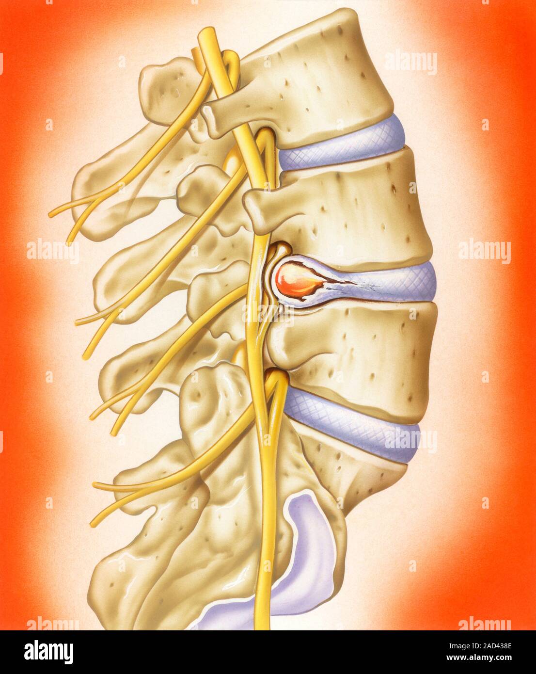 Slipped intervertebral disc. Illustration of a side view of the bottom ...