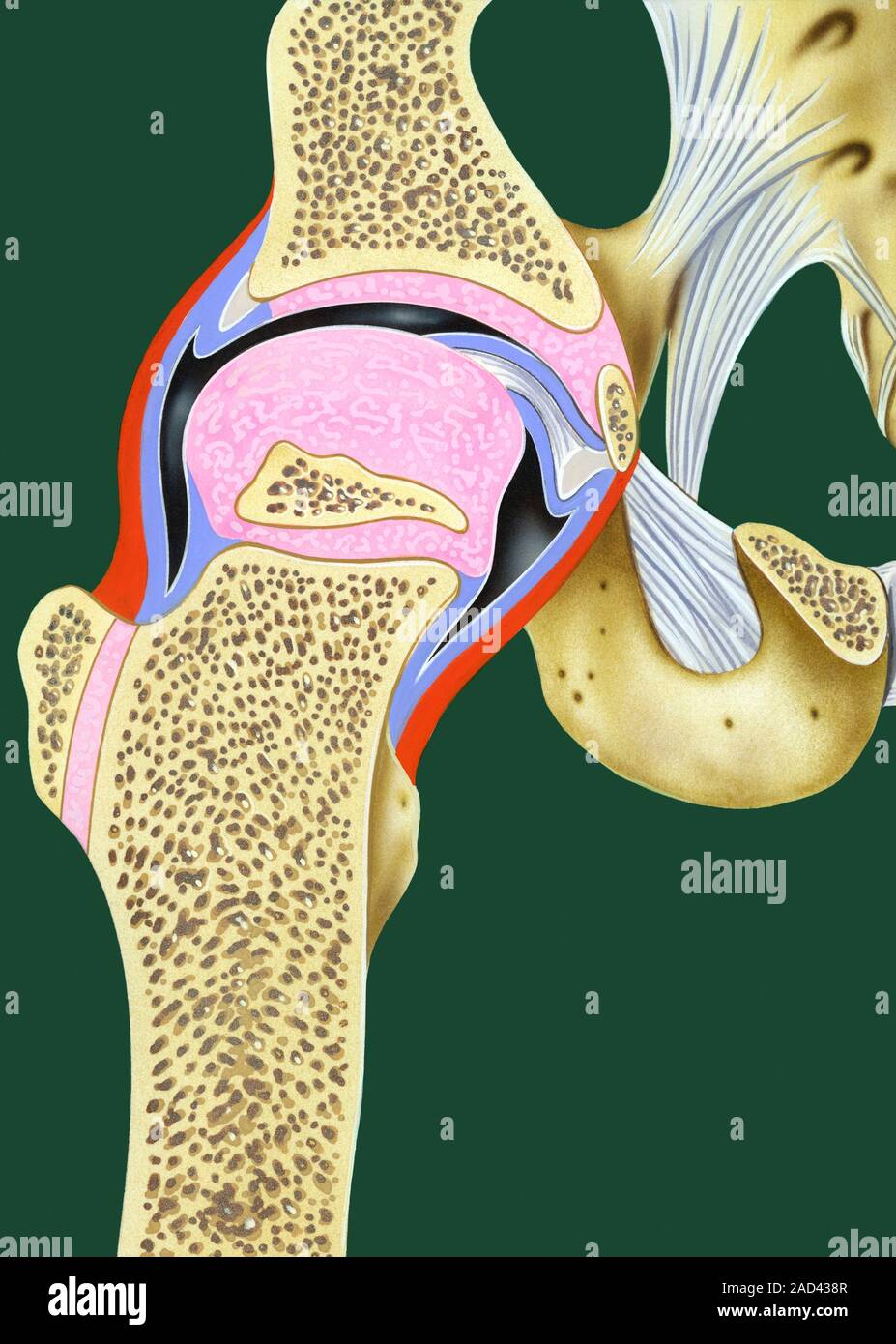 Femoral head deformity. Illustration of a frontal section through a ...